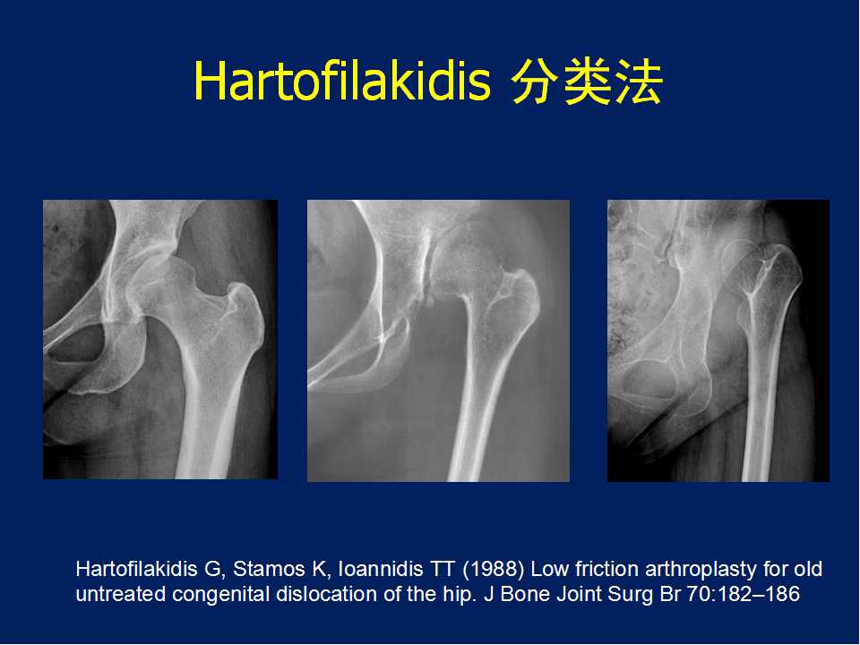 DDH自然病史观察 -医学文章-唯医,allinmd
