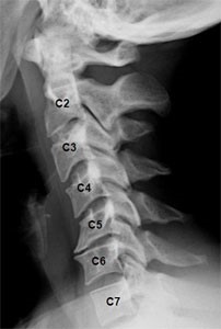 Cervical Stenosis, Myelopathy and Radiculopathy -医学文章-唯医,allinmd