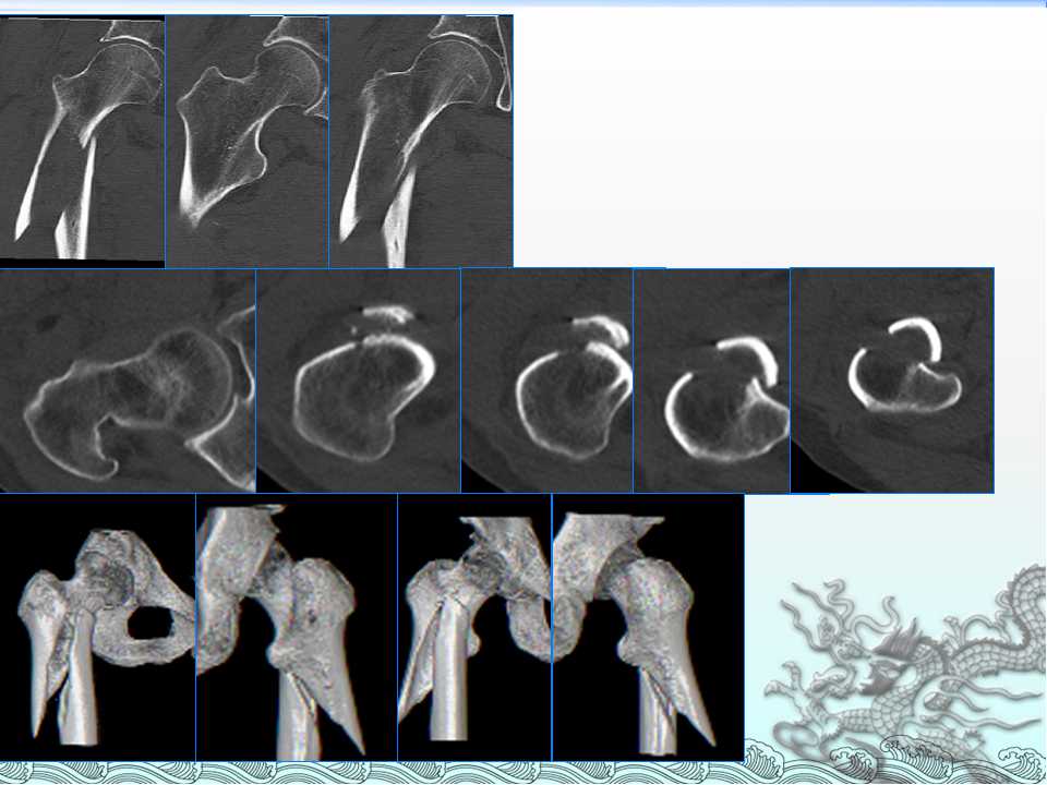 基于CT三维重建的股骨转子间骨折分型系统 -医学文章-唯医,allinmd