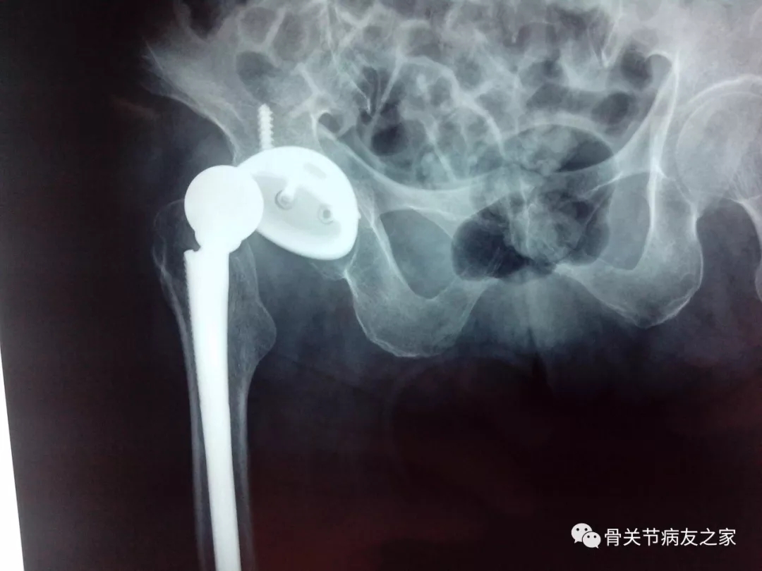 髋关节置换入路图谱,后侧,全髋_大山谷图库